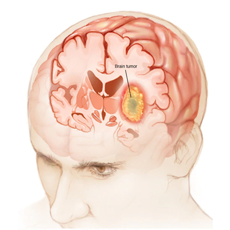 Brain And Spinal Tumors Houston Neurosurgery And Spine
